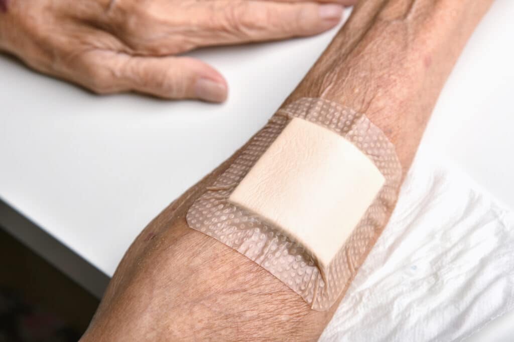 Wound Care After Staples Are Removed: Post-Staple Care Is Critical Care ...