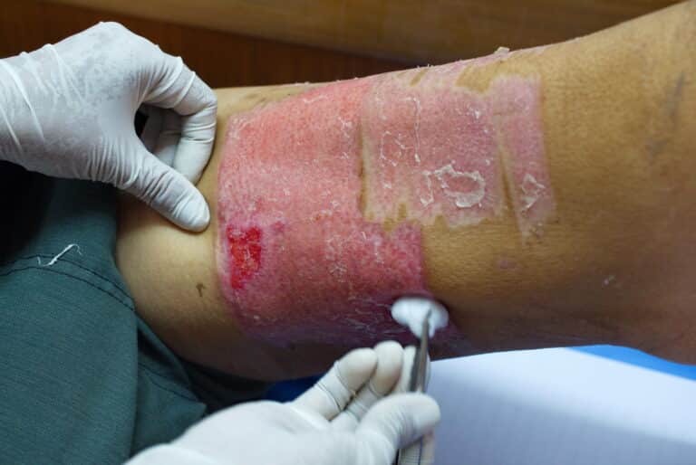 Avulsion Wounds: Tearing into Details - Net Health