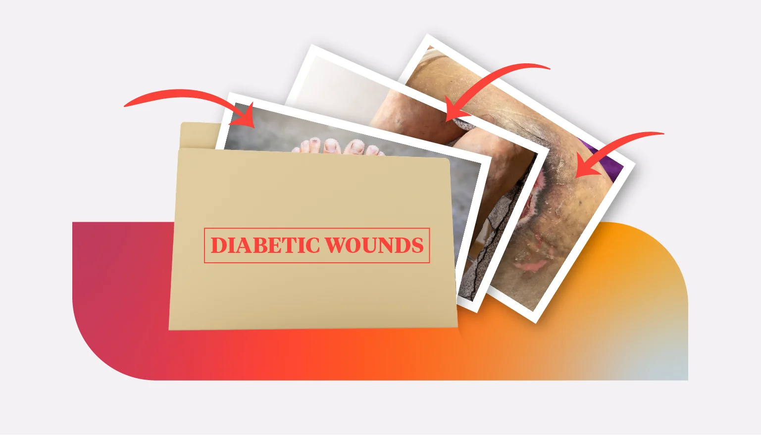 Types of Diabetic Wounds Providers Should Know - Net Health